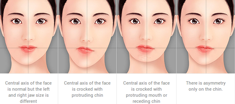 endopeel.support - The face is normally asymmetric and Endopeel can ...